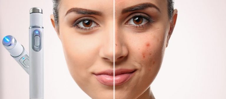 The Best Blue Light Therapy for Acne of 2025 - Top 10 Cold Laser Therapy